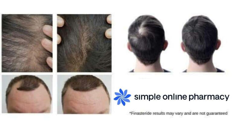 Finasteride Before And After: A Results Timeline | Simple Online Pharmacy