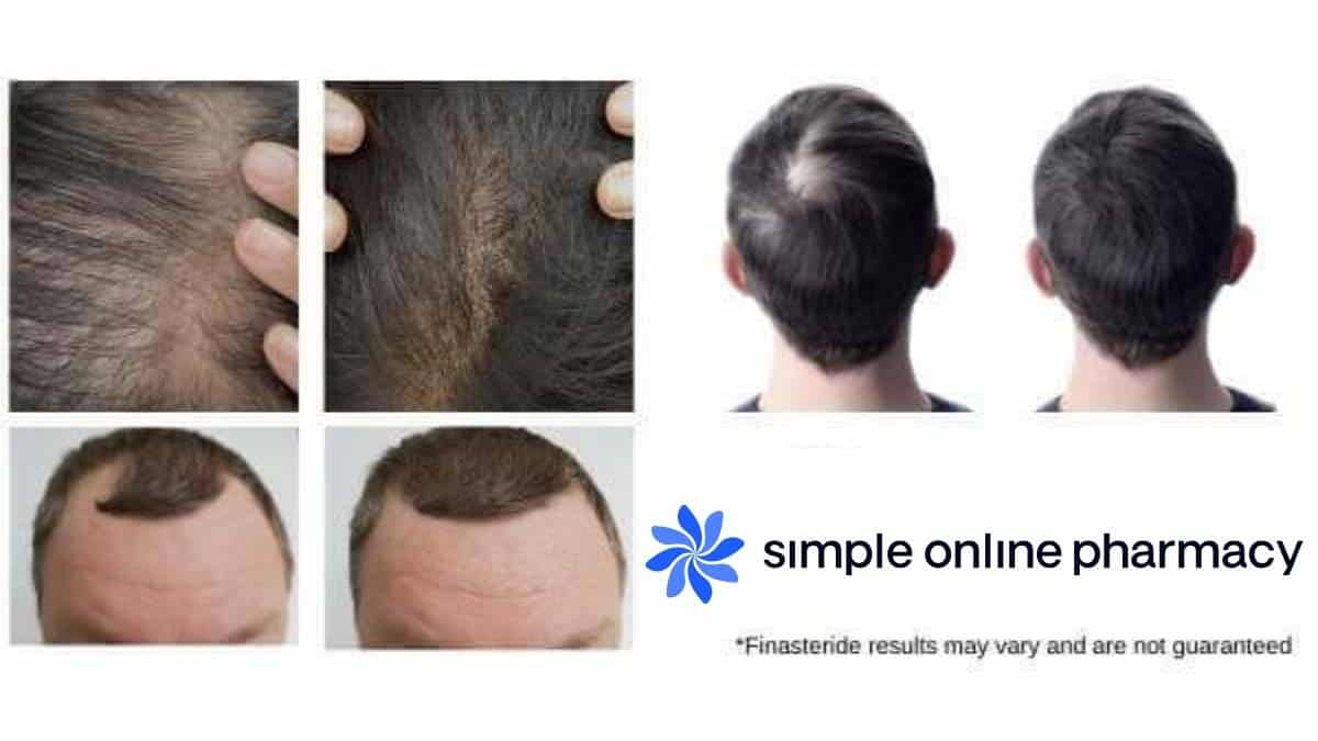 Finasteride Before And After: A Results Timeline | Simple Online Pharmacy
